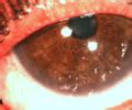 Cornea Extra Flashcards Quizlet