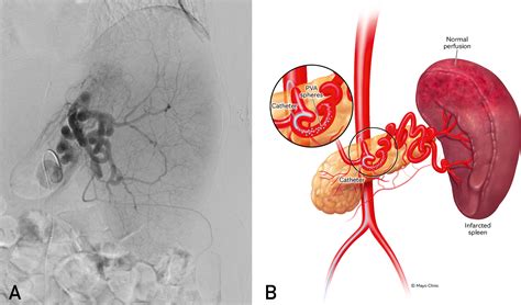 Interventional Radiology Partial Splenic Embolization For Refractory Thrombocytopenia In Still