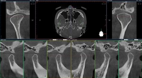 턱관절 장애 턱관절세정술 교근측두근 보톡스 턱관절보조장치 스플린트 찐생얼 네이버 블로그