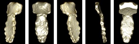 Figure 3 From 3 D Segmentation Of Human Sternum In Lung Mdct Images Semantic Scholar