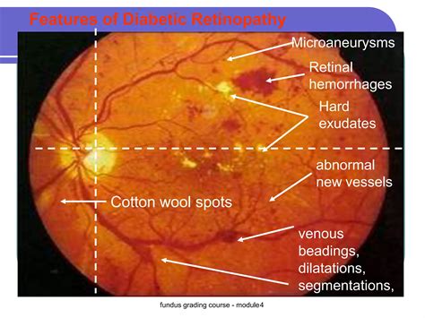Diabetic Retinopathy Present Pptx
