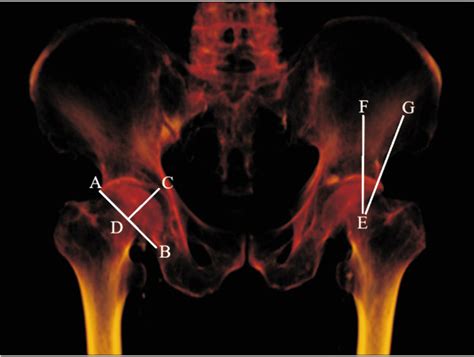 Differences In Acetabular Morphology Related To Sex And Side In South