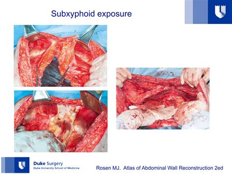 Abdominal Wall Anatomy With Respect To Understanding Component