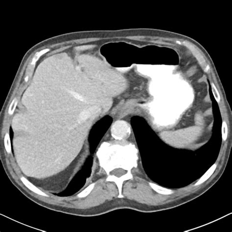 Amyand Hernia Radiopaedia 39300 41547 A Nc Commons