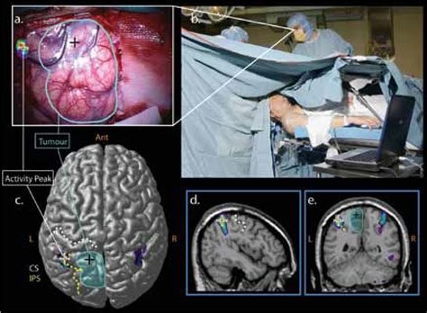 Neuronavigation System Used During Neurosurgery Overview Of The