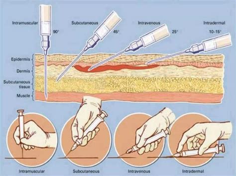Types Of Injection Routes Pptx