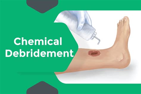 Chemical Enzymatic Debridement At George Redden Blog