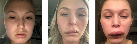 Us Hereditary Angioedema Association