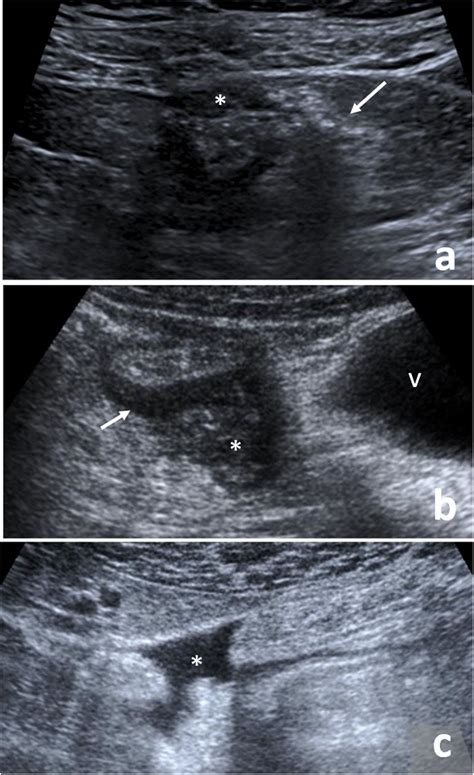 Classification Of Acute Diverticulitis In The Left Colon With Ultrasonography And Computed