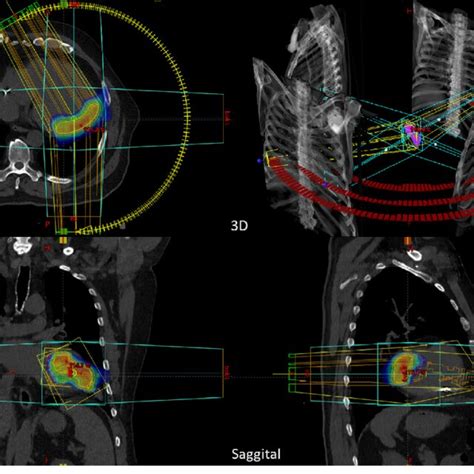 An Example Of Vmat Rt Delivery Plan Used In The Smart Vt Trial The Download Scientific Diagram