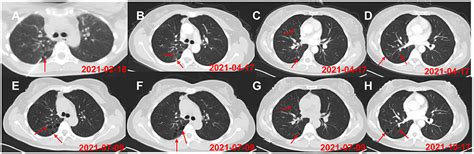 Fgfr2 Oncogenic Fusion Variant In Lung Adenocarcinoma Ott