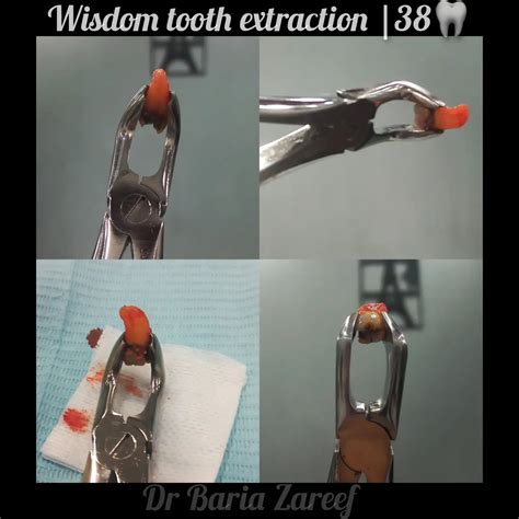 Dental Land Non Surgical Wisdom Tooth Extraction38 By