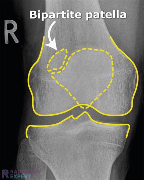 X Knee