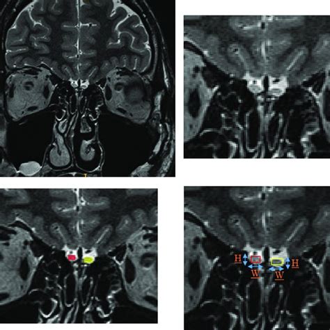 a whole brain mr scan from a single subject b right and left ob of