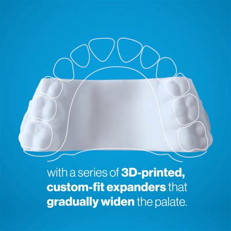 Invisalign Palatal Expander Goodman Orthodontics