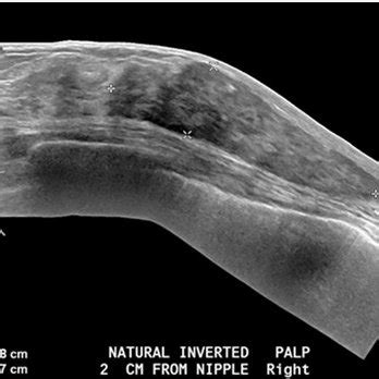 PDF An Uncommon Case Of Diabetic Mastopathy