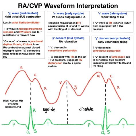 Ra Cvp Waveform Interpretation Rk Md Artofit