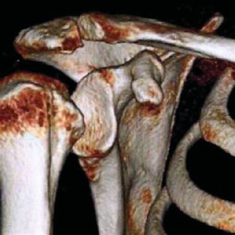 Pdf All Arthroscopic Mclaughlins Procedure In Patients With Reverse Hill Sachs Lesion Caused