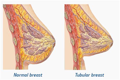 Cone Shaped Breasts A Silenced Concern Christinas Clinic
