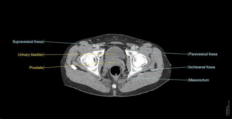 Abdomen And Pelvis Normal Anatomy E Anatomy 51 Off