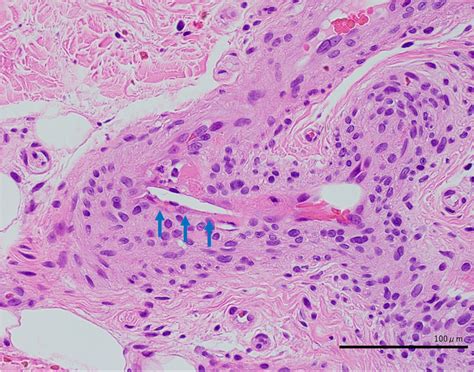 Histopathology Of The Palpable Purpura Which Exhibited A Cleft In A
