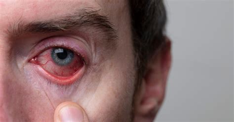 Periorbital And Orbital Cellulitis Mind The Bleep