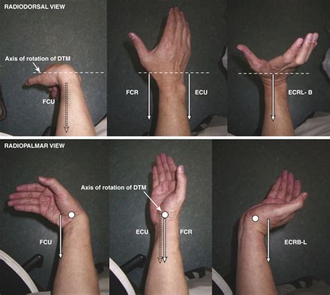 The Kinematics And Clinical Implications Of The Dart Throwing Motion Musculoskeletal Key