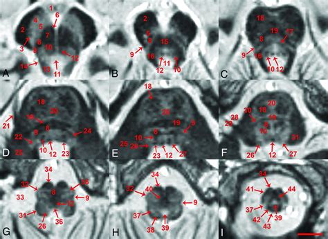 Brainstem Mri Anatomy
