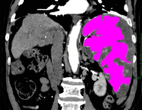 After Partial Splenic Embolization The Spleen Volume Was 102324 Cm³