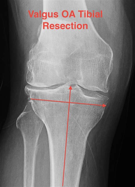 Valgus Tkr The Bone School
