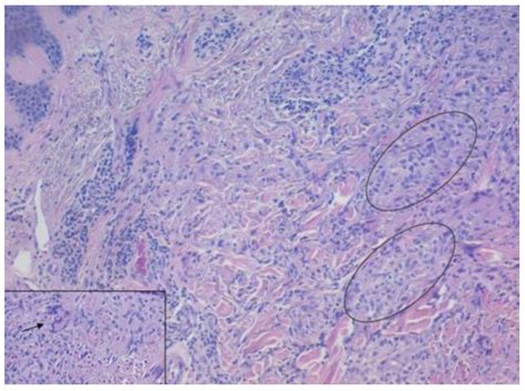 Multifocal Tuberculosis Verrucosa Cutis Case Report And Review Of The Literature