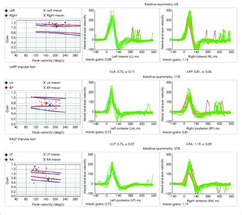 Results Of The Video Head Impulse Test Performed On Day 5 Head Impulse
