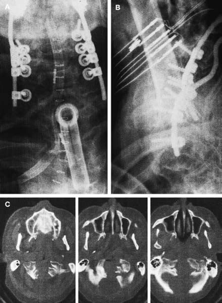 Endoscopic Assisted Transoral Odontoidectomy Neupsy Key