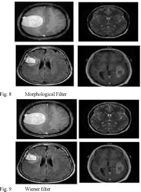 Figure 8 From Median Filter Based Denoising And Classification Of Mri