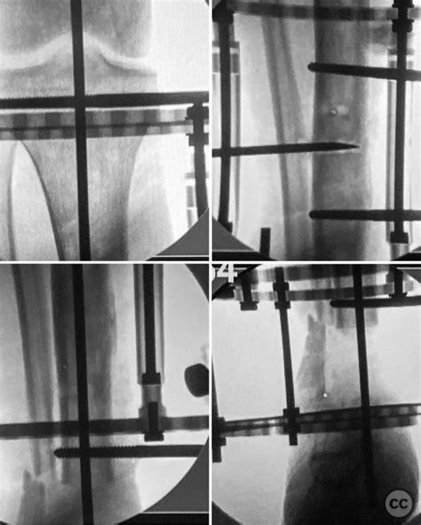 Staged Debridement Transport And Nailing Of An Open Distal Tibia With Critical Bone Defect