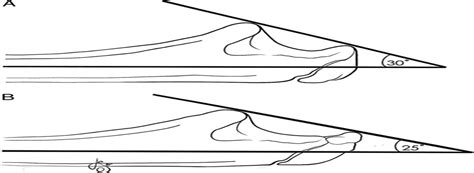 The Ulnar Olecranon Coronoid Notch Angle Affects Terminal El Journal Of Pediatric Orthopaedics