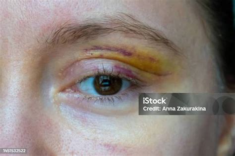 성형 수술 안검 성형술 눈에 보이는 눈 상처 부은 눈 주머니 부은 피부 봉합사 및 타박상 눈꺼풀 후 여성 얼굴 회복 주름의 치유