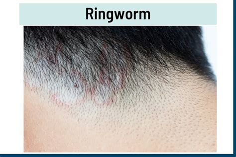 8 Rashes That Look Like Ringworm But Arent With Pictures