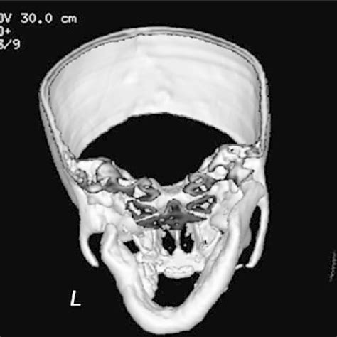 Pa Skull Projection With Midline Deviation Of The Mandibular Midline