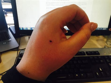 Why I Got A LinkedIn Enabled Microchip Implanted In My Hand