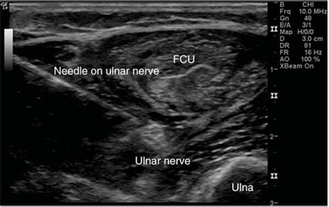 Ulnar Nerve Injection Wikism Sports Medicine Wiki