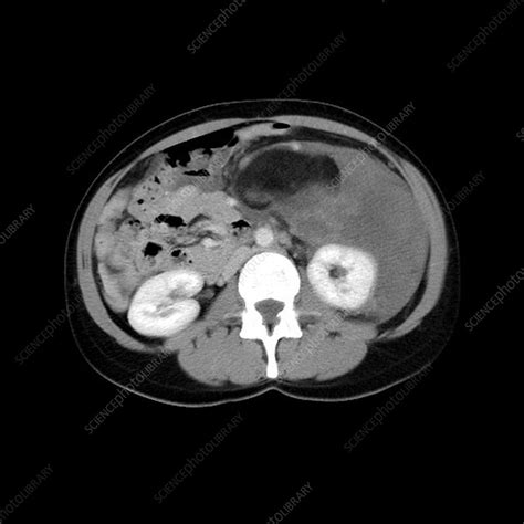 Liposarcoma Mri Scan Stock Image C0119587 Science Photo Library
