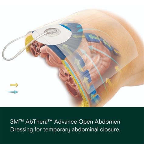 Abthera Wound Vac