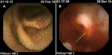 Optimising The Use Of Small Bowel Endoscopy A Practical Guide Pmc