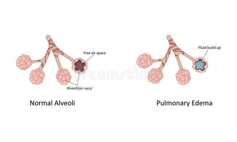 Pulmonary Edema Vector Illustration Stock Vector Illustration Of