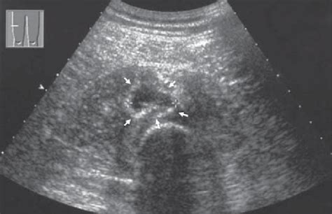 Myositis Ossificans Circumscripta Moc Of Left Anterior Thigh In Download Scientific Diagram