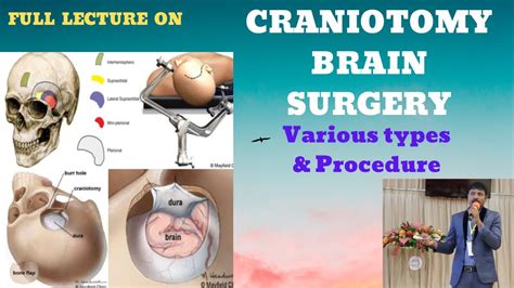 Craniotomy Brain Surgery Various Types Of Craniotomy And Procedures