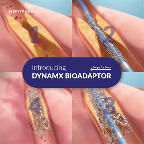Inovasi Pengobatan Penyakit Arteri Koroner Dengan Elixir Dynamx Bioadaptor Meditrans Global
