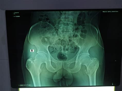 Radiology Bone Collection Opensea