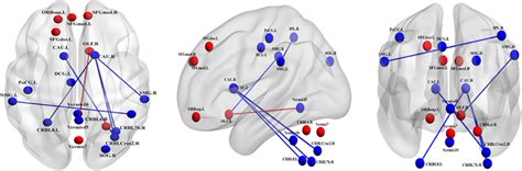 Altered Functional Connectivity Within The Network Of Disrupted Areas